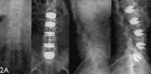 Biocompatibility and anatomy-tailored elasticity come together in a ...